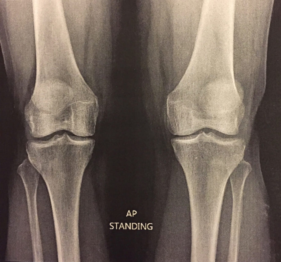 Hypermobility Part 1: AM I Hypermobile and Why Should I care? - Mind 2 ...